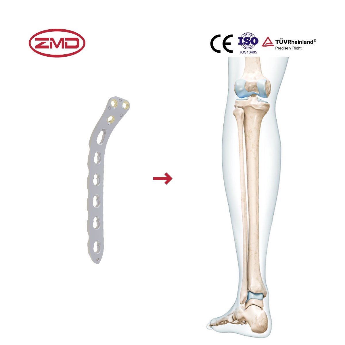 Multi-Axial Tibia Proximal Lateral Locking Plate I - Pharmaceutical Company