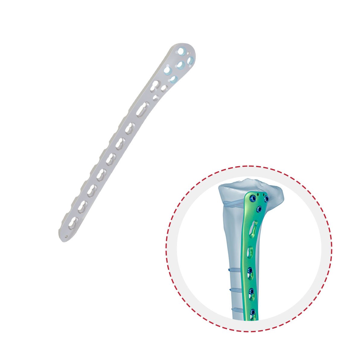 Multi-Axial Tibia Distal Medial Locking Plate II - Pharmaceutical Company