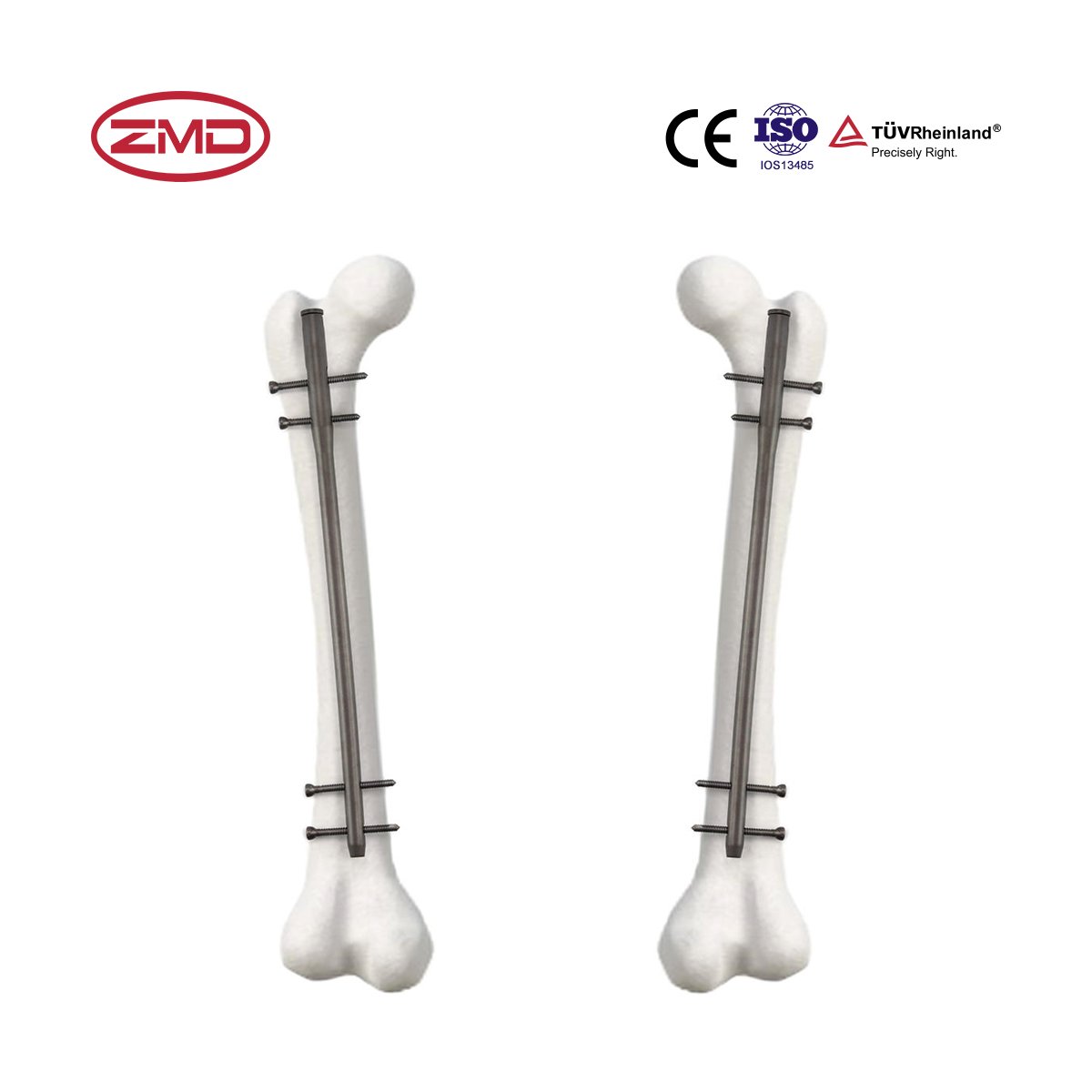 Femoral Gamma Lockable Intramedullary Nail - Pharmaceutical Company