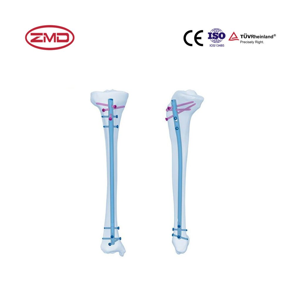 Tibia Lockable Intramedullary Nail - Pharmaceutical Company