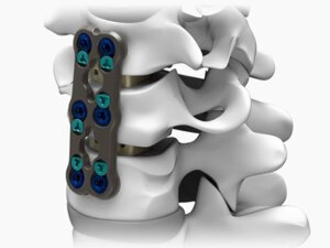 Anterior Cervical Plate System - Pharmaceutical Company