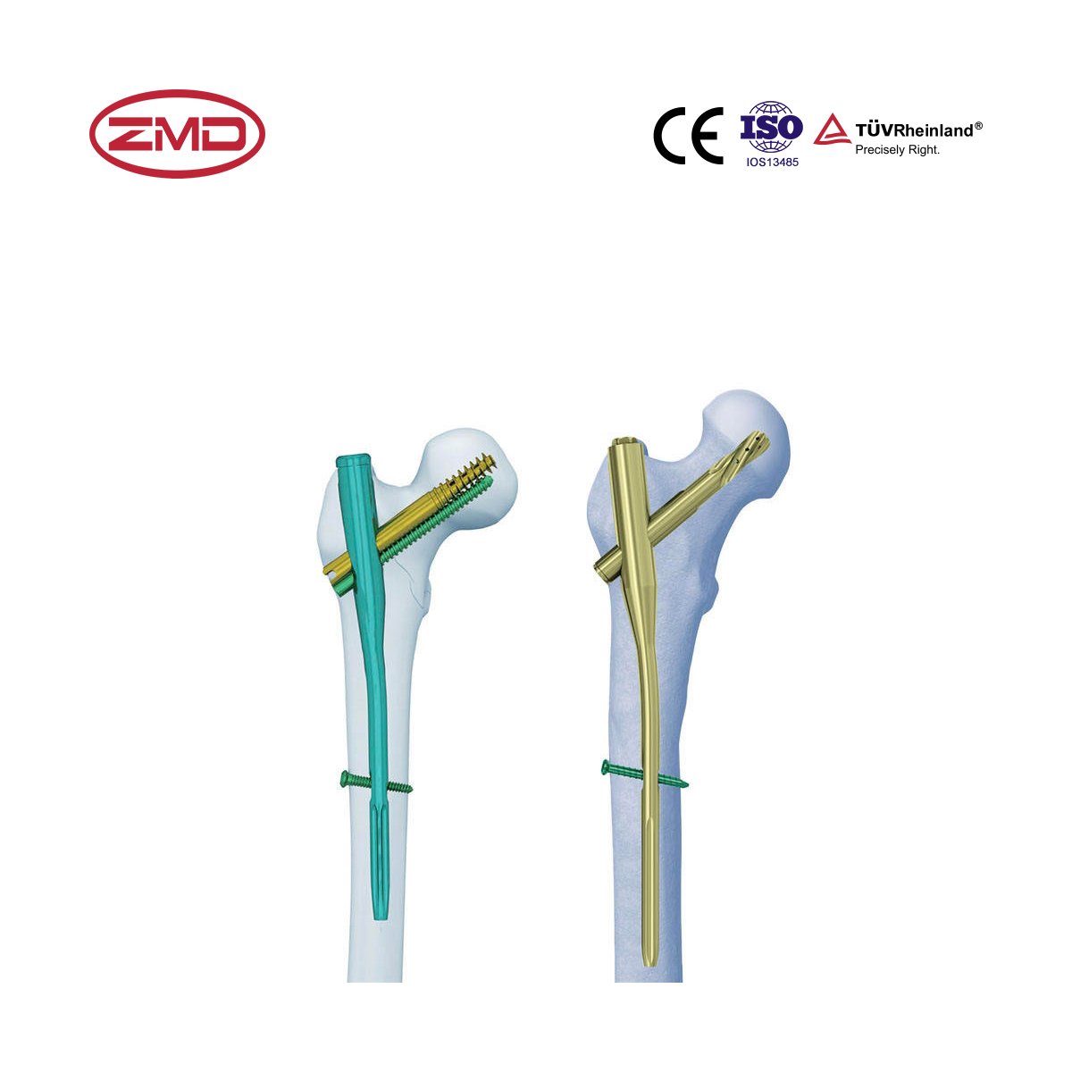 Tibial Suprapatellar Lockable Intramedullary Nail - Pharmaceutical Company