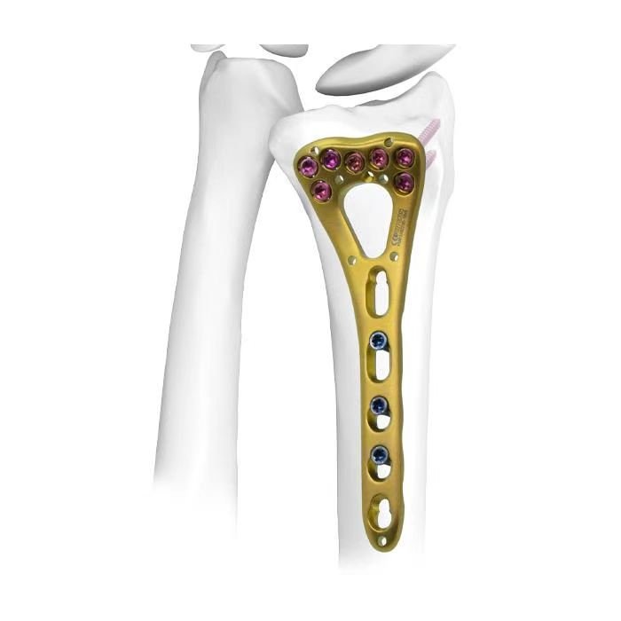 T Plate Distal Radius for Orthopedic Use - Pharmaceutical Company