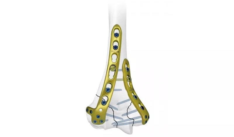 Proximal Tibia Medial Plates: Function and Market Insights ...