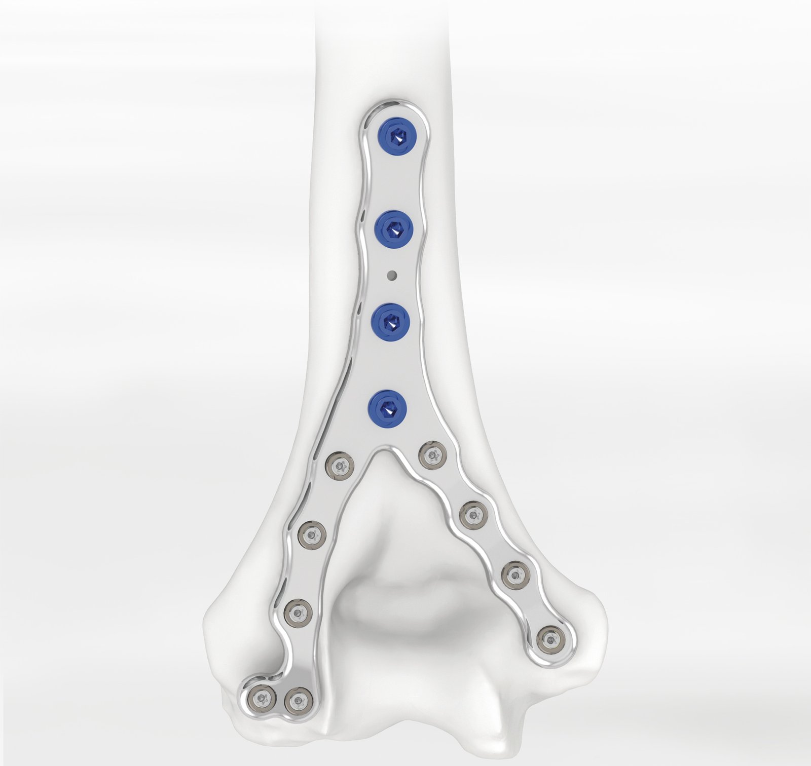 Proximal Tibia Locking Plate Applications Explained - Pharmaceutical ...
